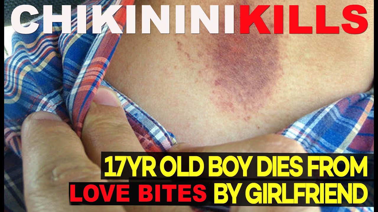 Cause of Death: Chikinini (Love Bites) l Random Trivia l Fun Facts l ...