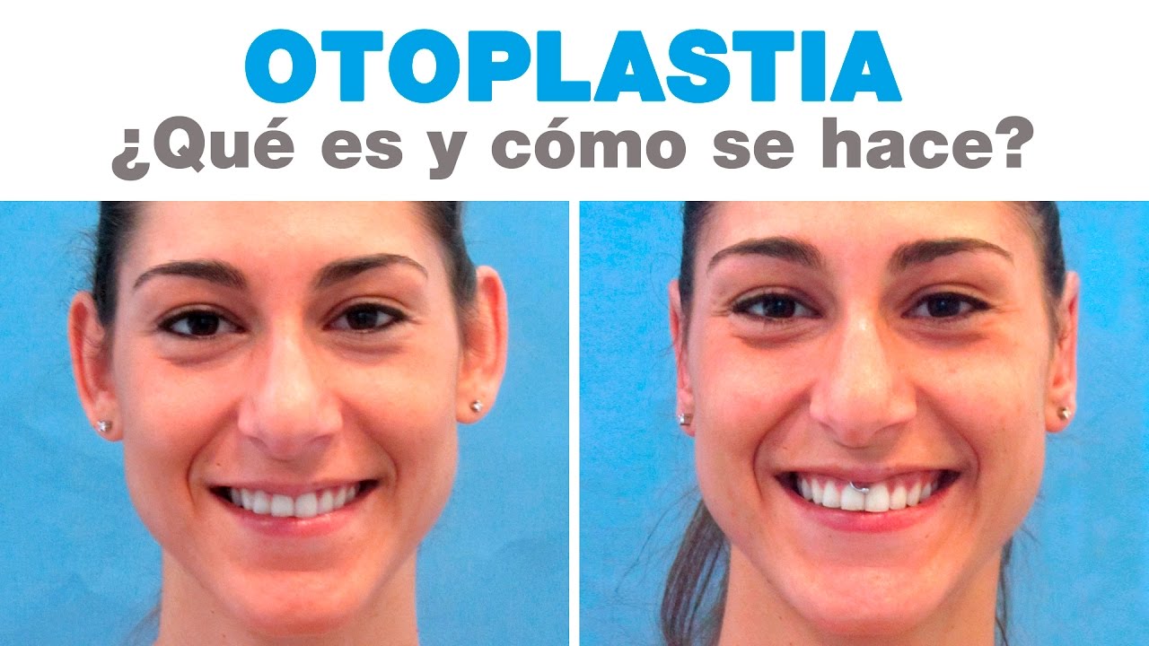 Otoplastia: Qué es y Cómo se hace la Cirugía de Orejas | Clínicas Diego ...