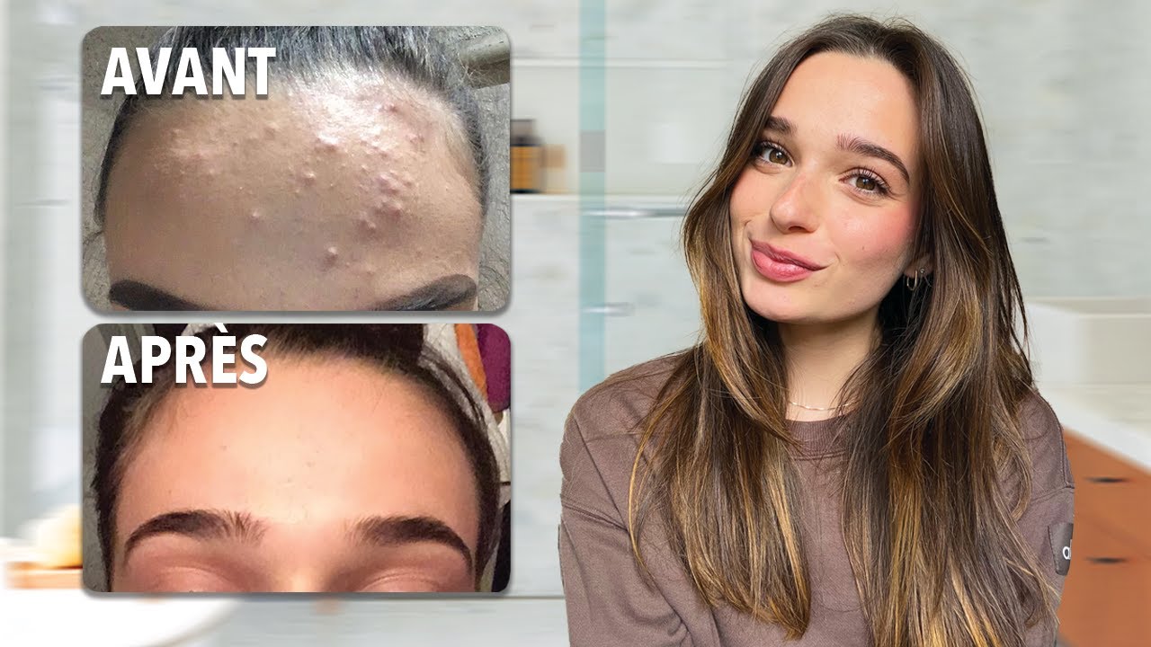 COMMENT J'AI FAIT DISPARAÎTRE MES BOUTONS ET CICATRICES D'ACNÉ | Andie ...