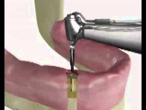 Myriad-Snap™ Dental İmplant Sistemi Cerrahi Aşama