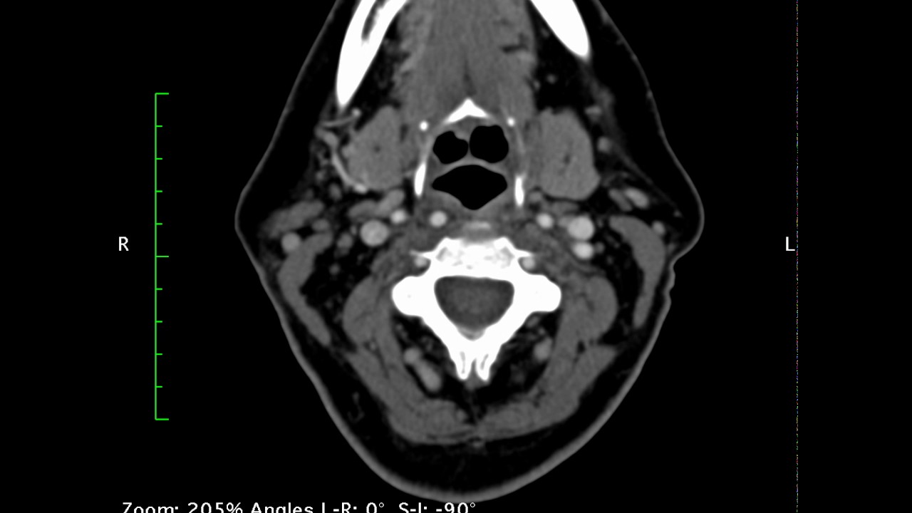 CTA head and neck stroke - YouTube