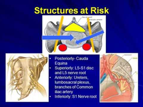 PELVIS: Perctaneous SI screw - YouTube