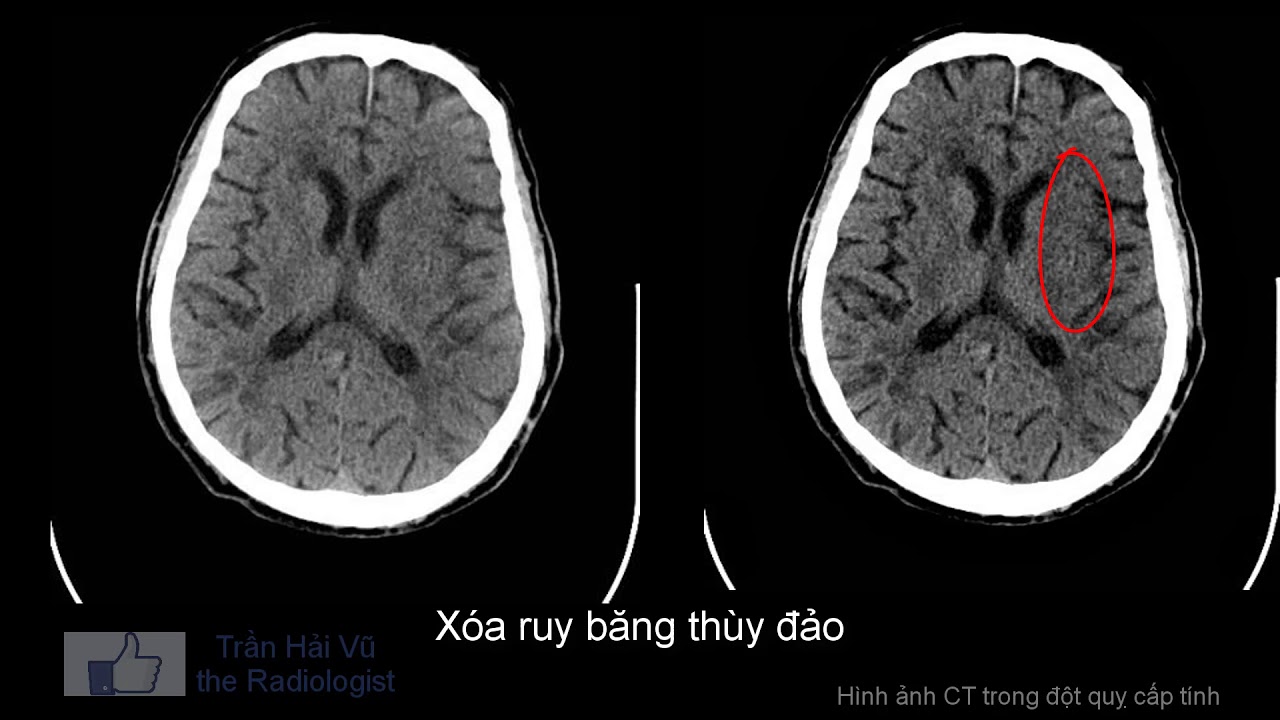 Hình ảnh CT trong nhồi máu não giai đoạn sớm. - YouTube