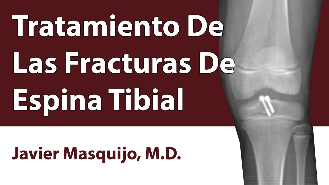 Tratamiento De Las Fracturas De Espina Tibial - YouTube