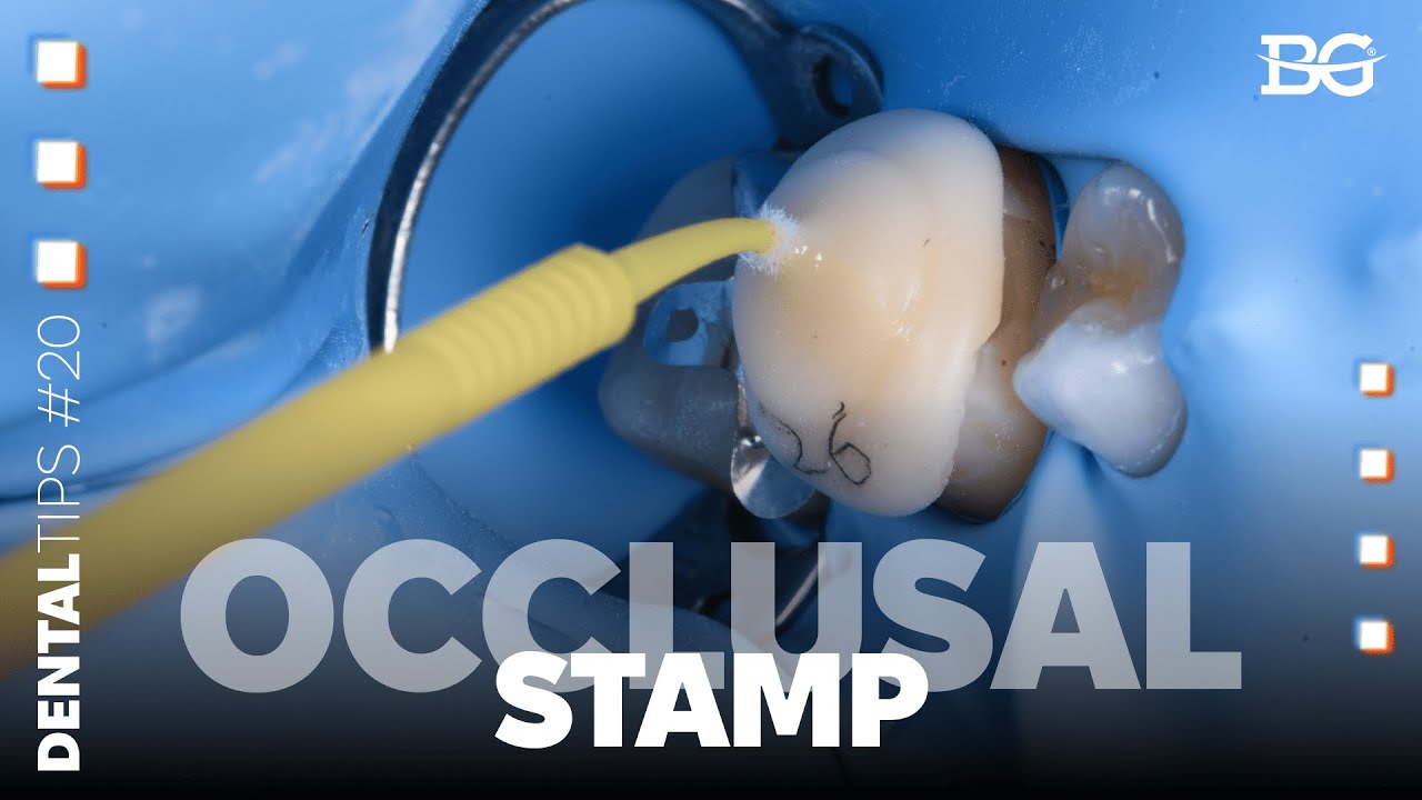 Occlusal stamp from a wax-up model - YouTube