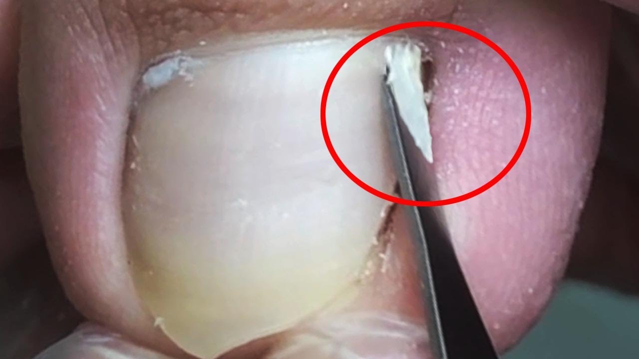 Perfectly trims the sharp corners at the base of the toenails！【DrZhang ...