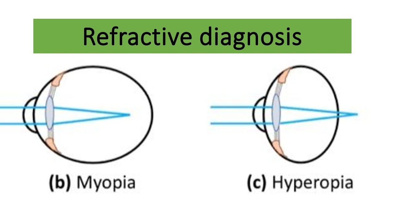 Refractive diagnosis made easy #optometry #optometristlife - YouTube