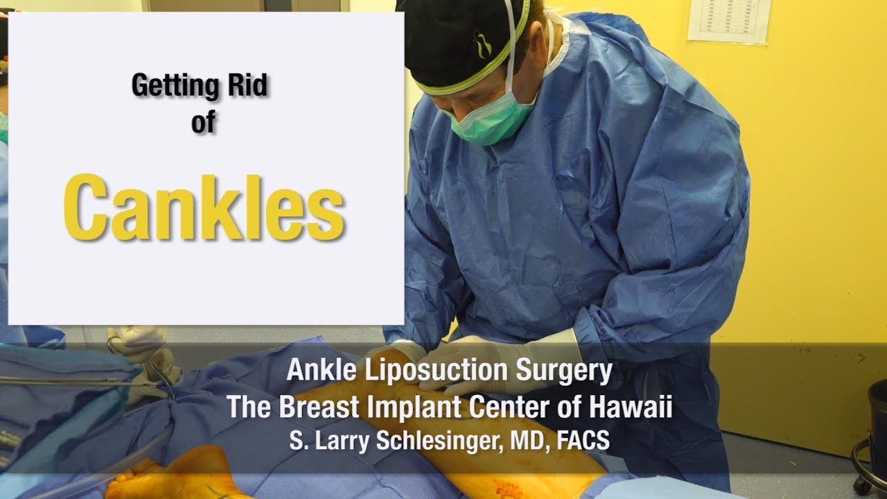 How to Get Rid of Cankles - Ankle Liposuction Surgery in Hawaii - YouTube