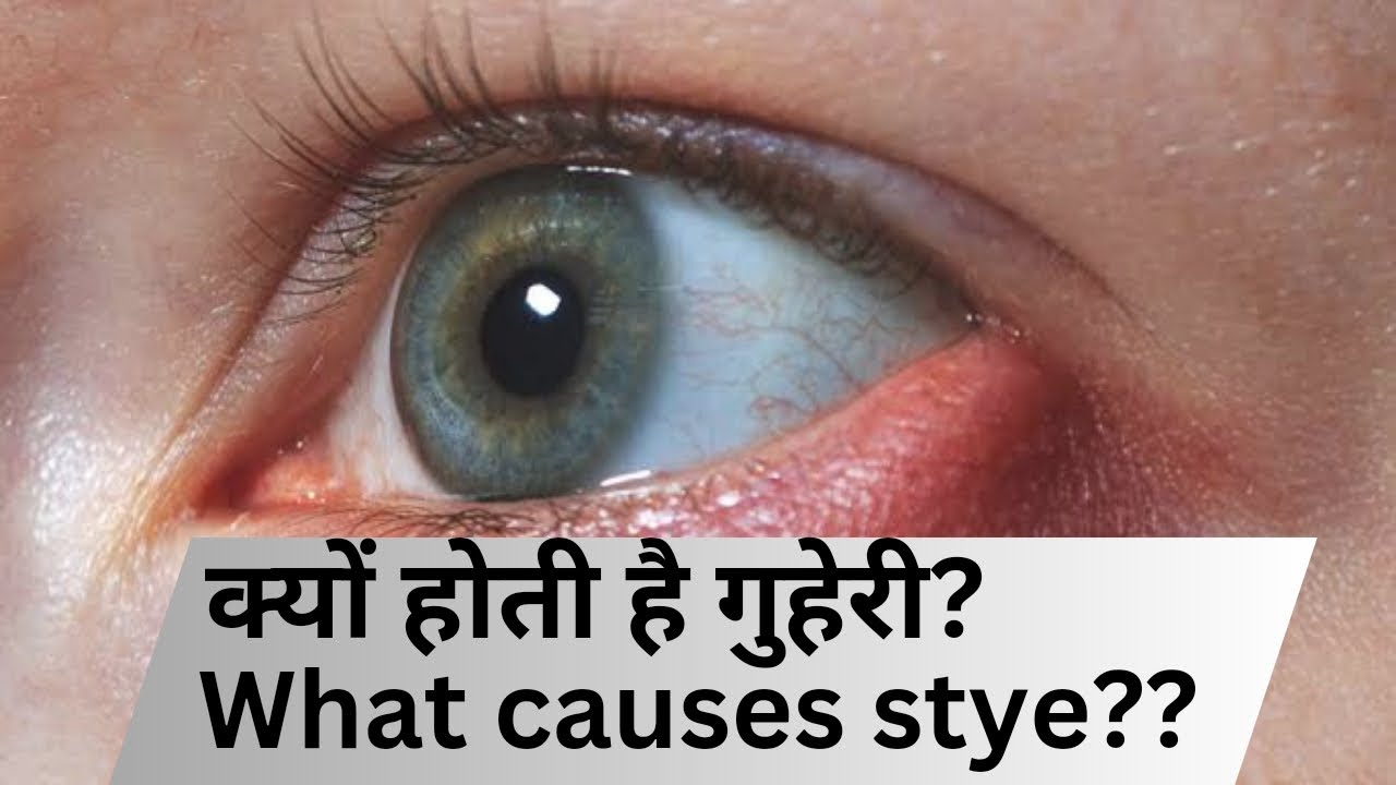 What Causes A Stye