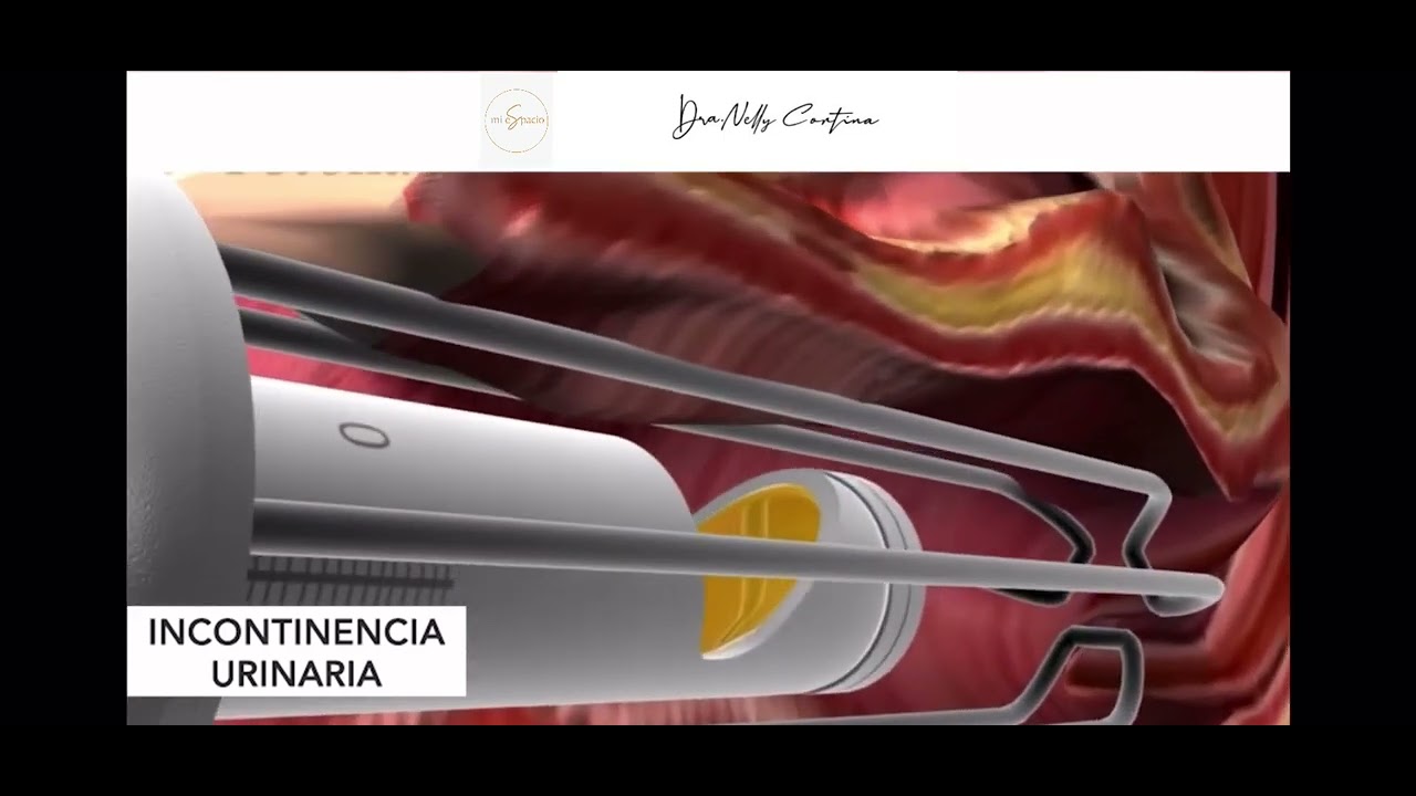 Conoce cómo se realiza el tensado vaginal - YouTube