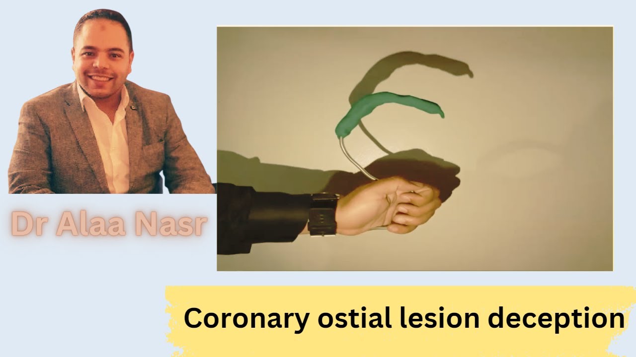 Ostial lesion deception in coronary angiography made easy, Dr Alaa Nasr, 2023 - YouTube