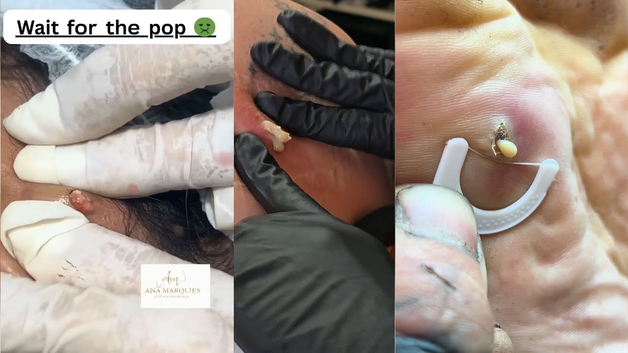Popping huge blackheads and Pimple Popping - Best Pimple Popping Videos ...