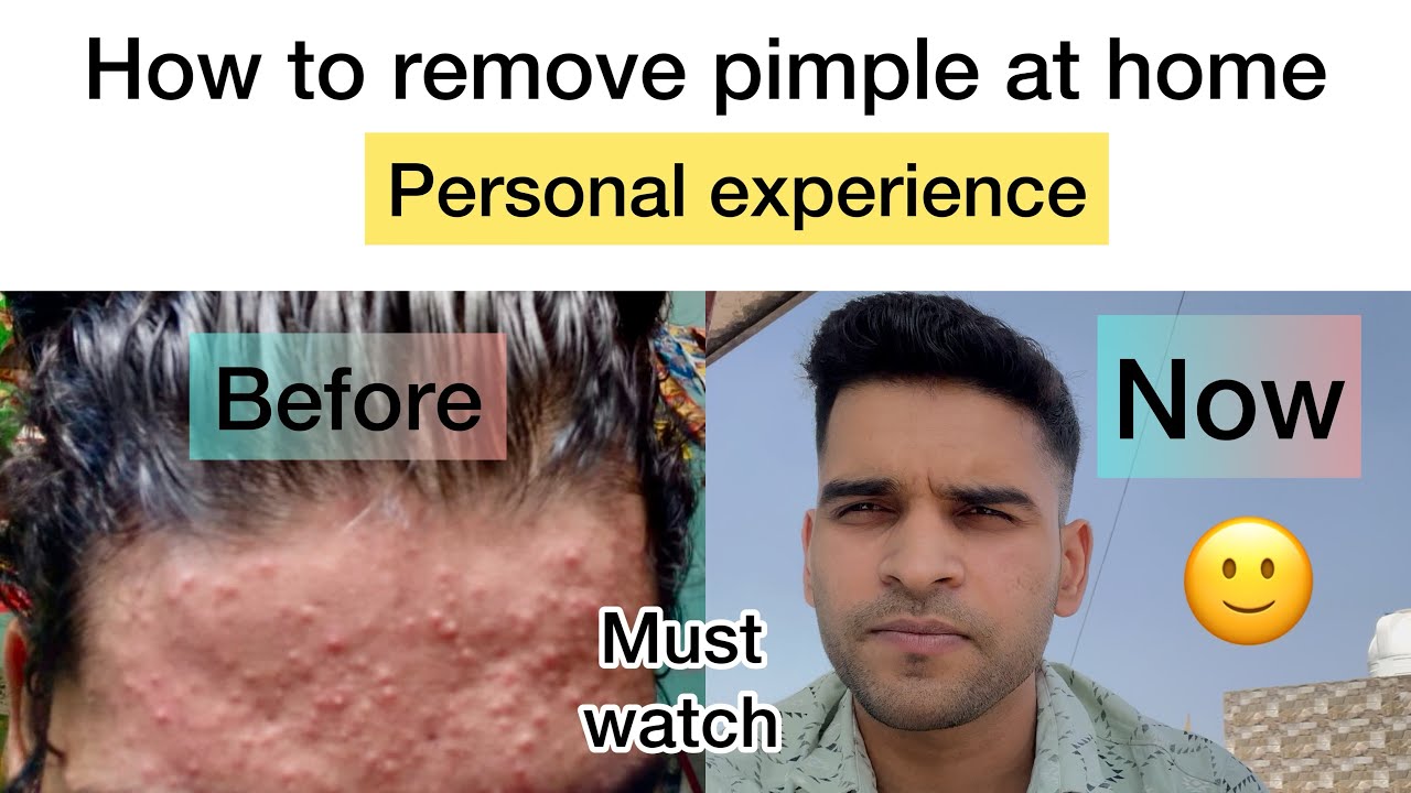 How to remove pimple at home || my personal experience || neem ke patte ...