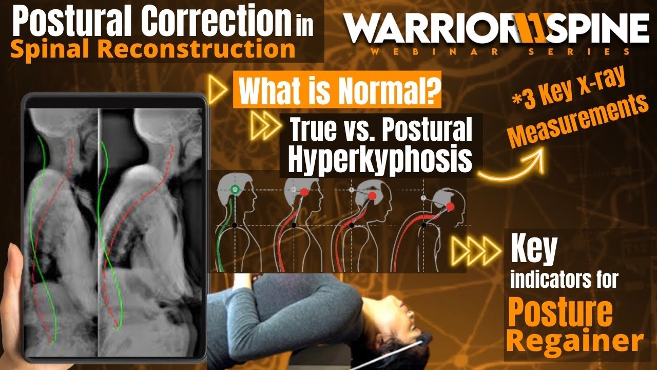 Postural Correction in Spinal Reconstruction | Warrior1Spine - YouTube