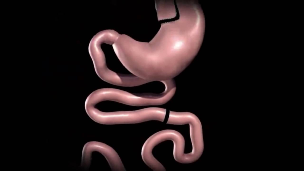 Gastric Bypass - Animation - YouTube