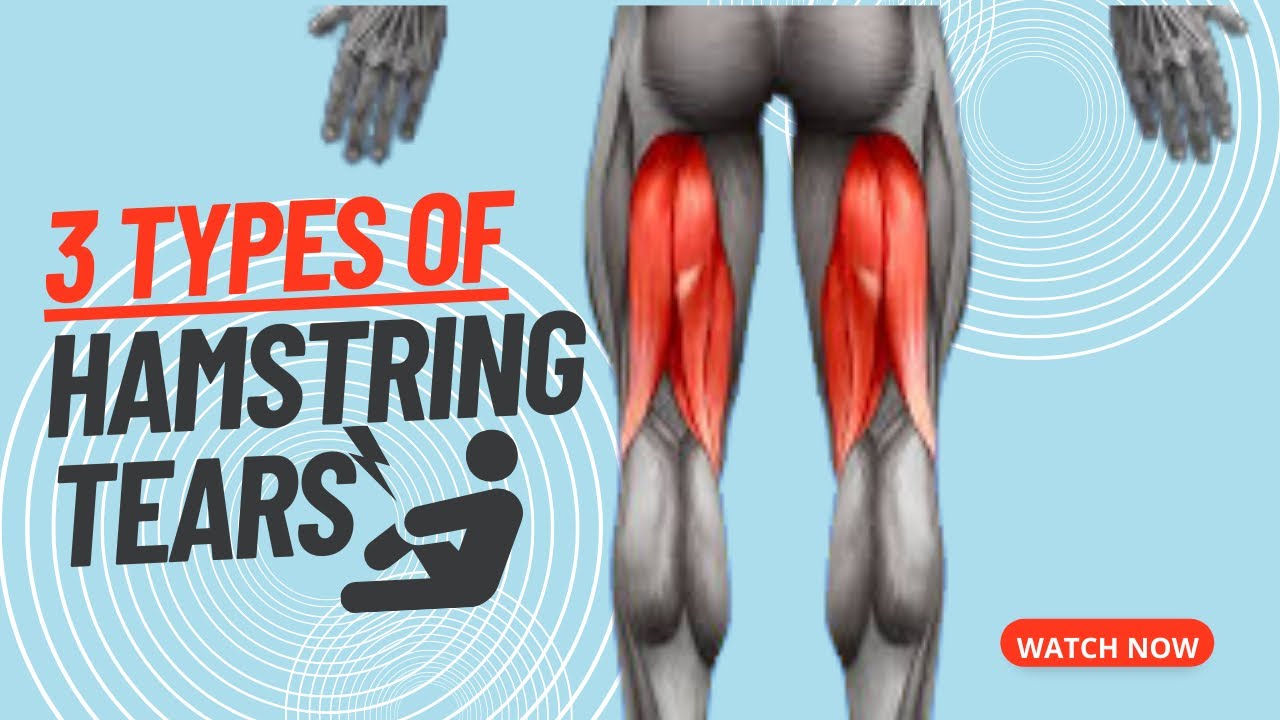 Hamstring strain and a pulled hamstring are the same thing - Here’s Why ...