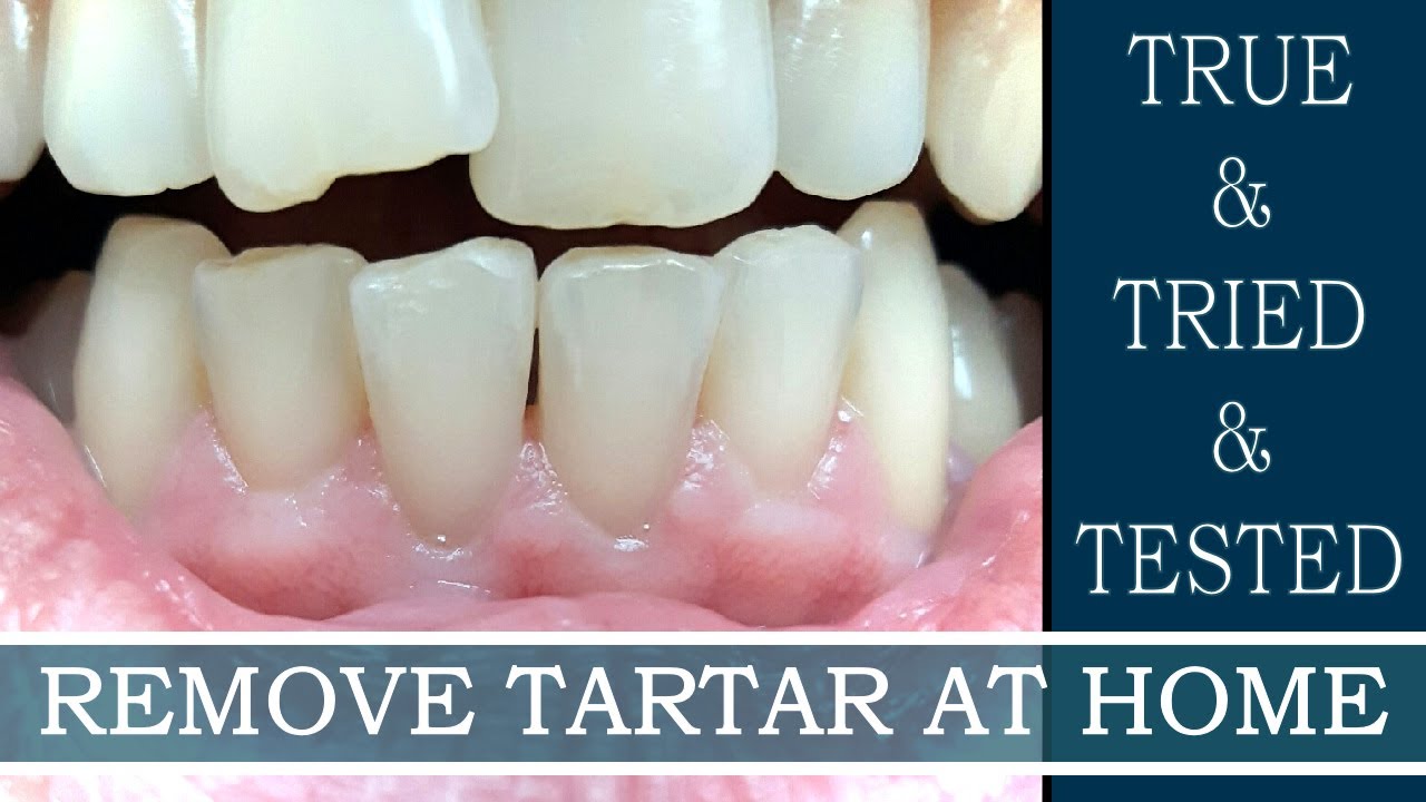 SCALE YOUR TEETH AT HOME, REMOVE TARTAR, ORAL HYGIENE WITH LACTIC ACID ...