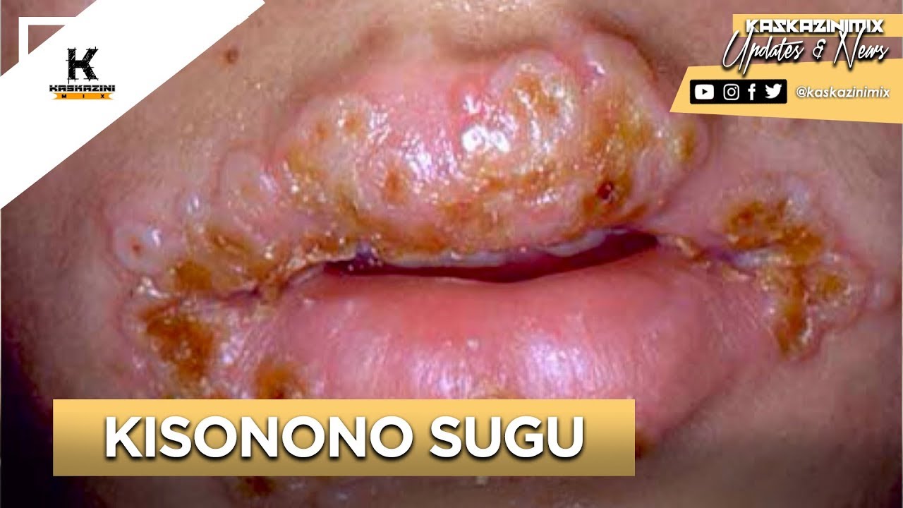 DALILI NA TIBA ZA UGONJWA WA KISONONO SUGU - YouTube