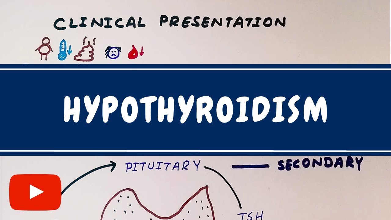 Hypothyroidism Made Easy (with management & dosage) - YouTube