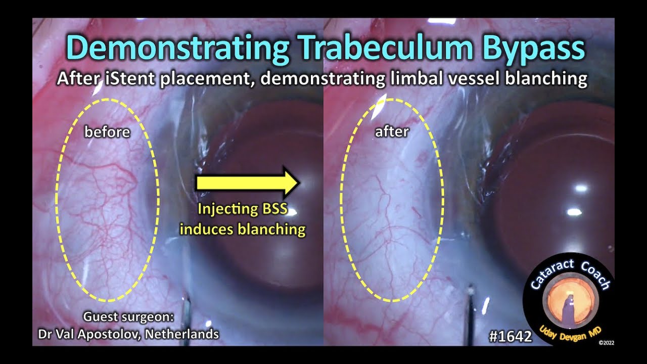 CataractCoach 1642: demonstrating trabeculum bypass with iStent MIGS ...
