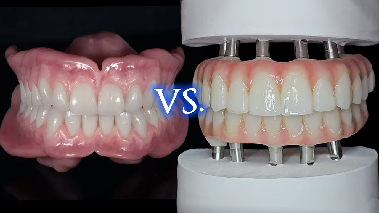 DENTURES vs IMPLANTS vs SNAP-INs vs All-On-4! Pros & Cons Of Permanent ...