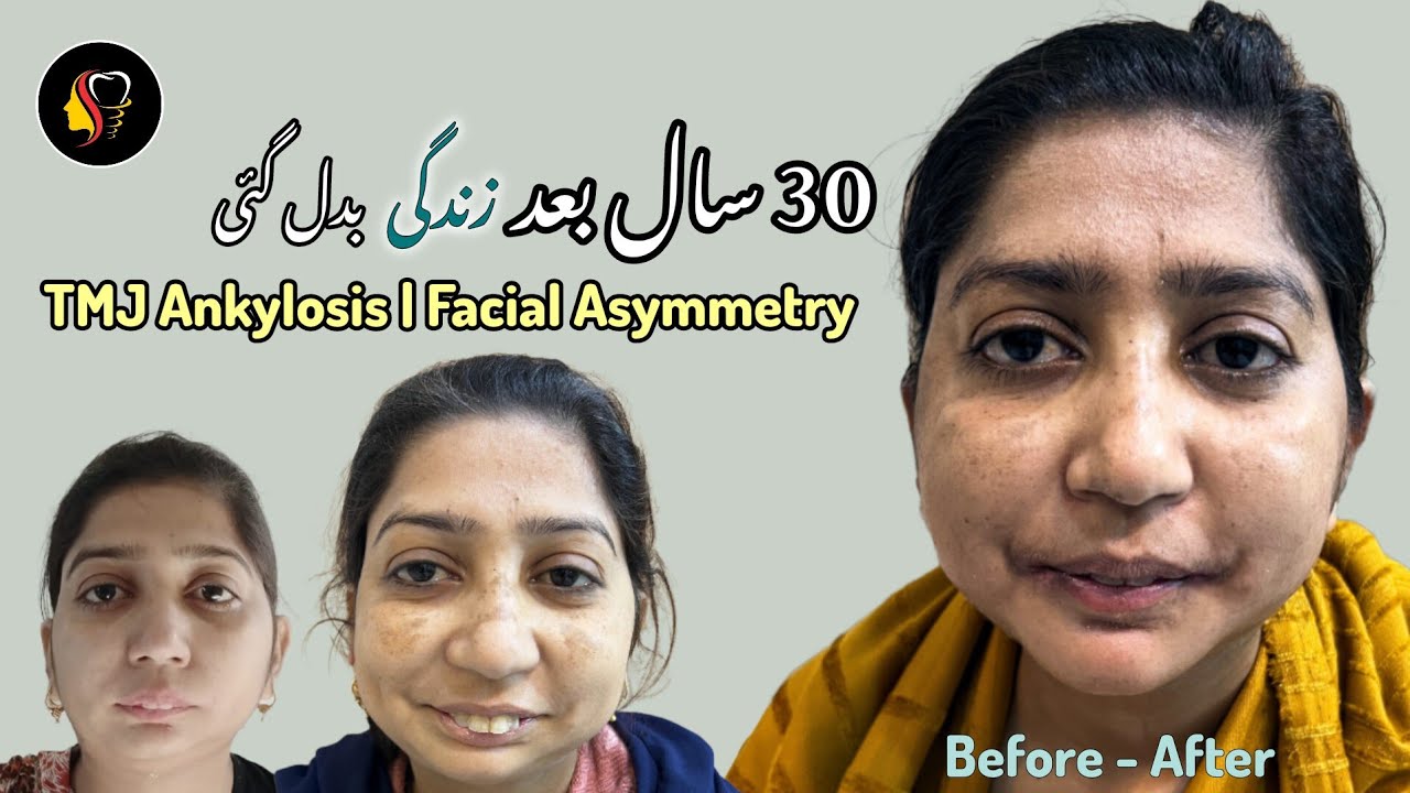 Tmj Ankylosis | Short Mandible | Facial Asymmetry Treatment at Aldaim ...