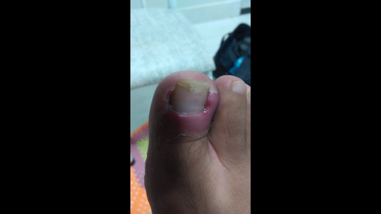UNHA MUITO INFLAMADA, MACHUCADA E ENCRAVADA! PACIENTE COM MUITA DOR ...