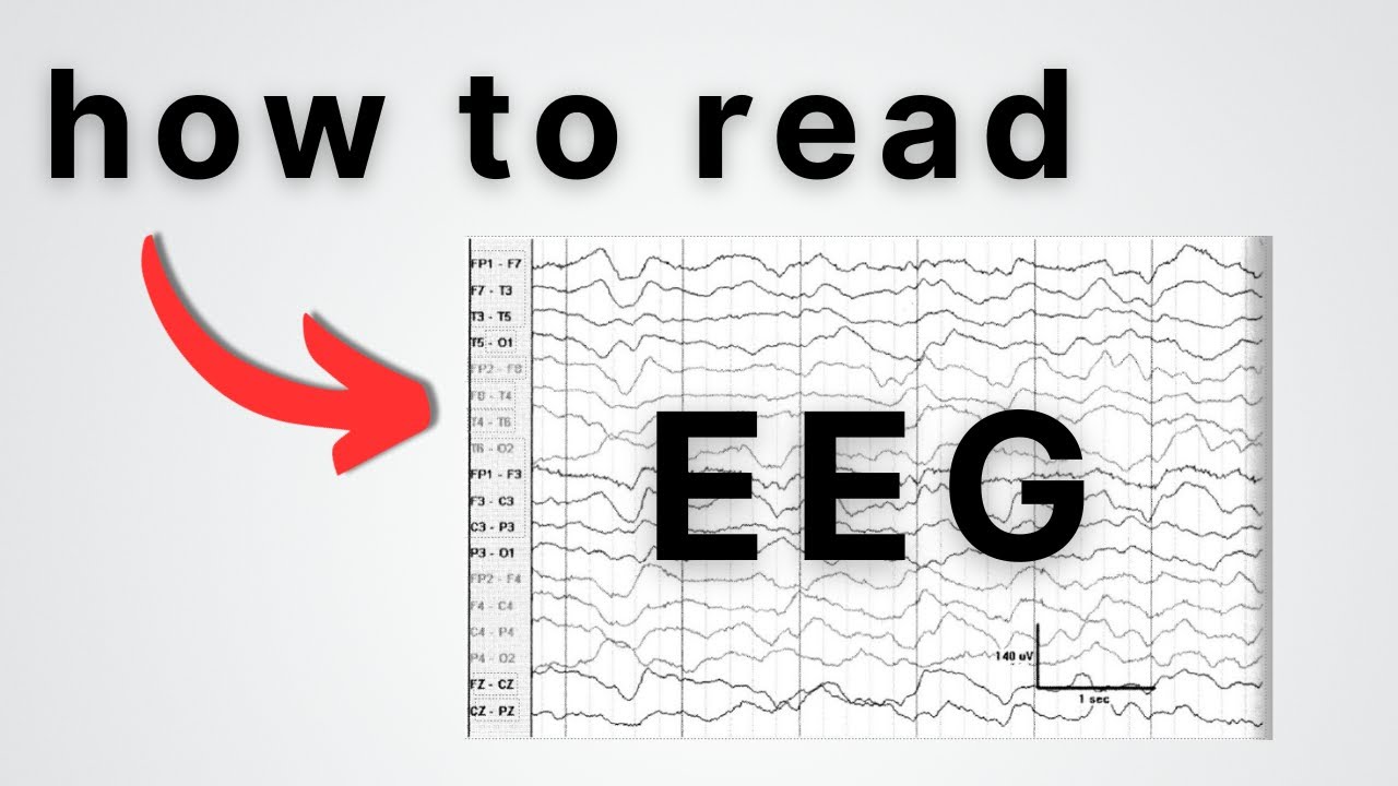 Unlock EEG: Understanding Continuous Generalized Slowing - YouTube