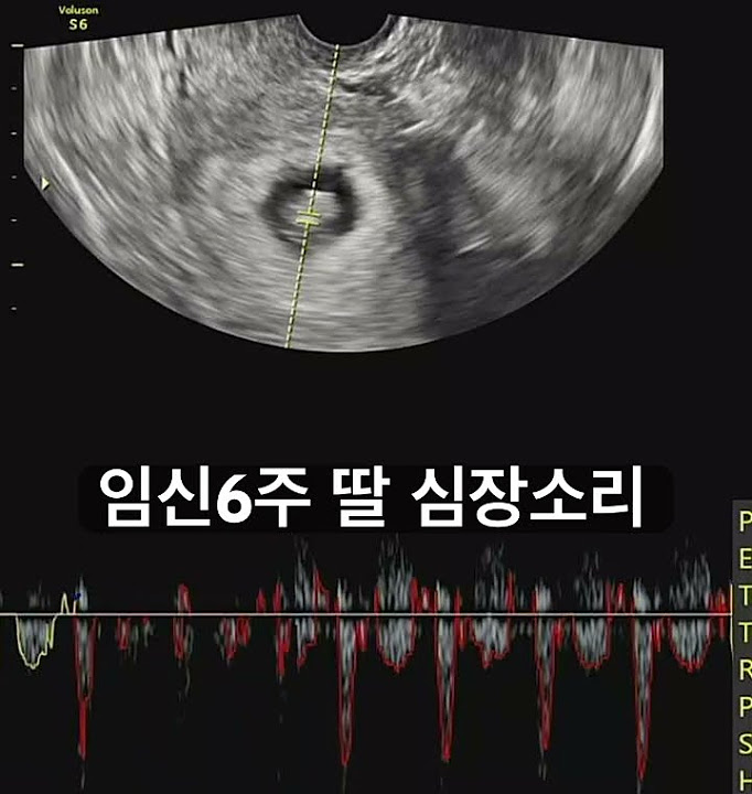 Tahap Awal Kehamilan 임신초기 6주차 초음파 딸 심장소리 ️ Youtube