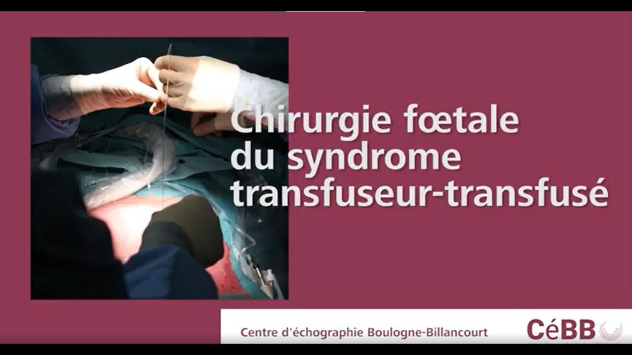 LA CHIRURGIE FOETALE : Le Syndrome Transfuseur-Transfusé ou STT - YouTube