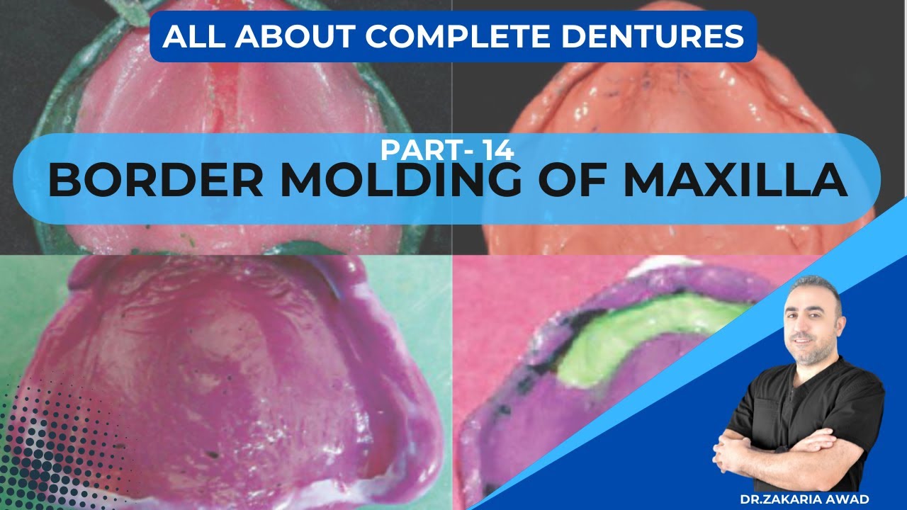 14- Maxillary Border Molding - طبعة الحواف للفك للعلوي - YouTube