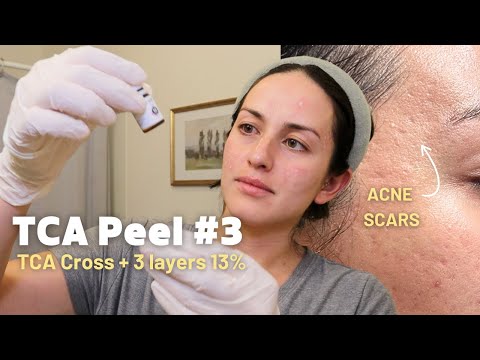 TCA Peel + TCA CROSS for Acne Scars: Before & After Close-Up! Day By Day Updates