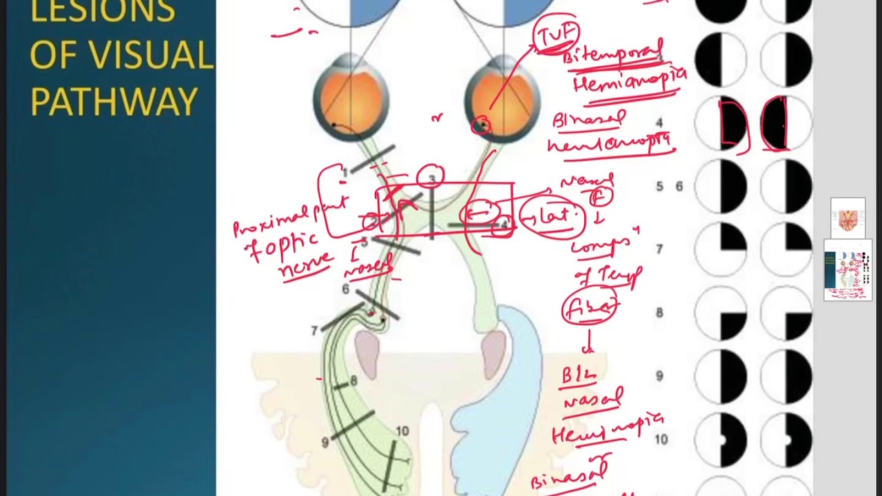 LESIONS & CLINICAL ANATOMY OF VISUAL PATHWAY......... - YouTube