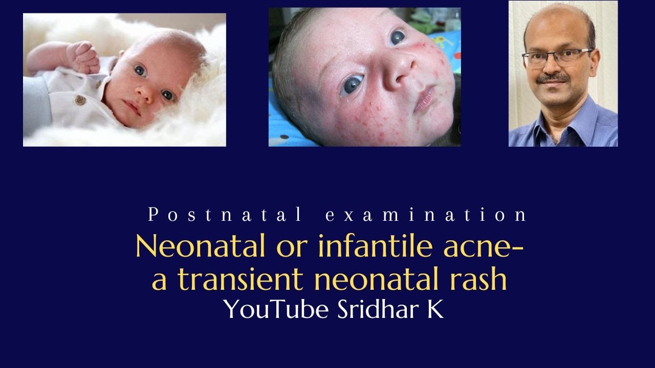 Infantile Acne