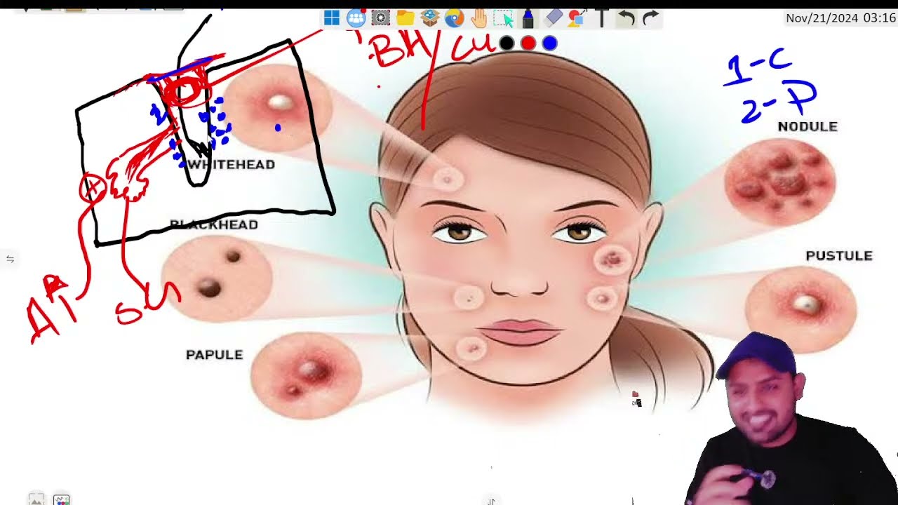 Acne | Master The OPD Demo Lecture | Dr S.M Huzaifa - YouTube