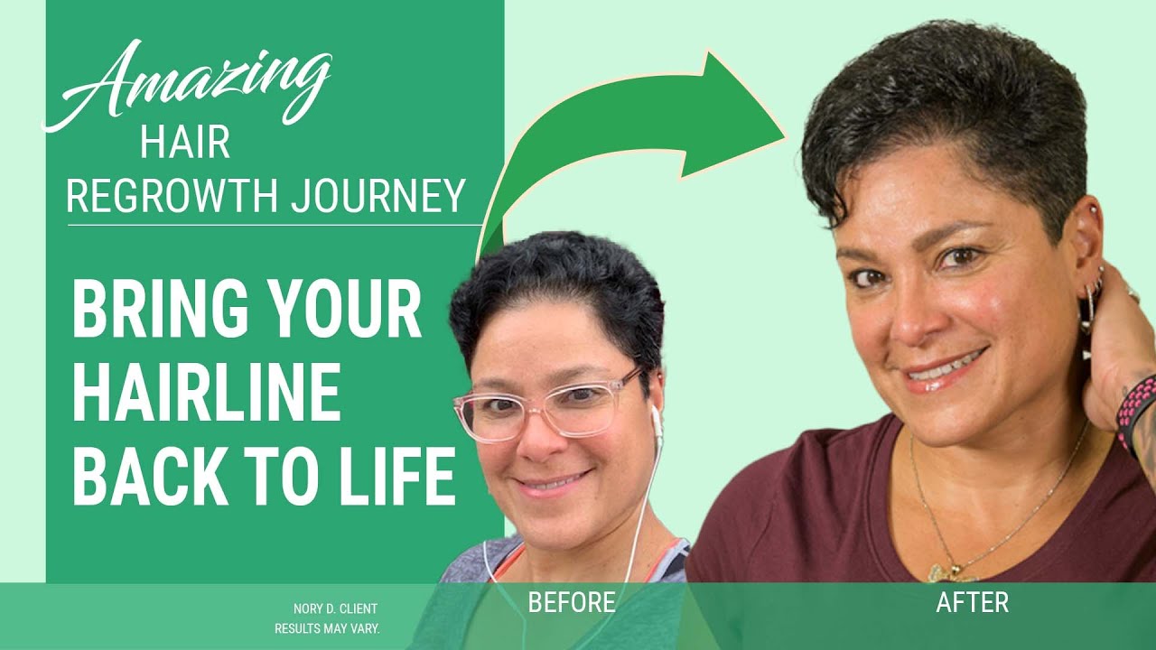 HairClub’s EXT Treatments Helped Bring Nory’s Hairline Back to Life ...