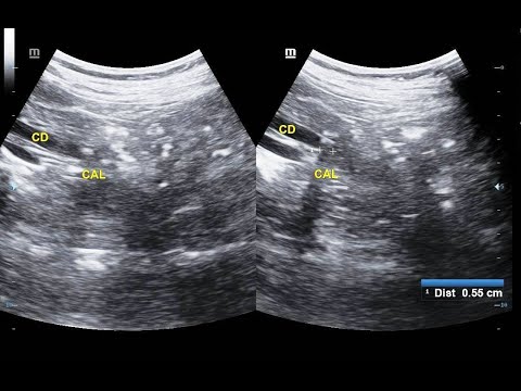 STONE IN COMMON BILE DUCT USG - YouTube