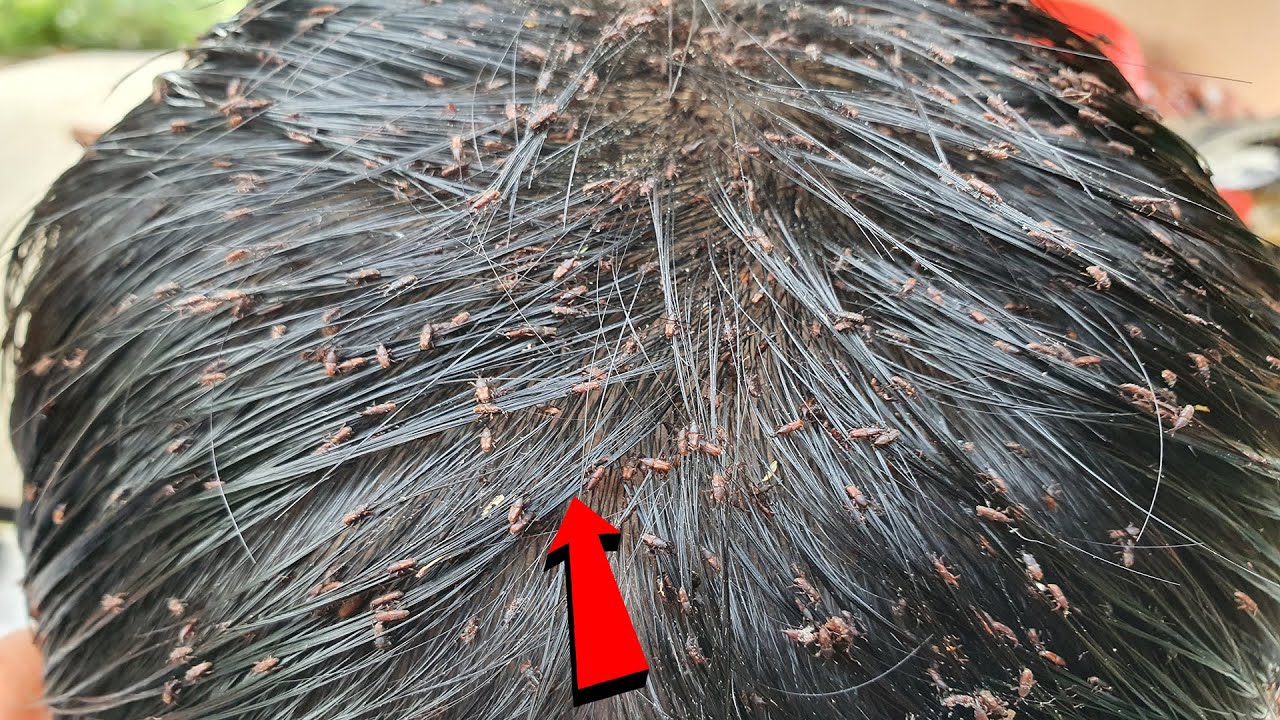 Beautiful short hair lice removal on boy - Lice comb - YouTube