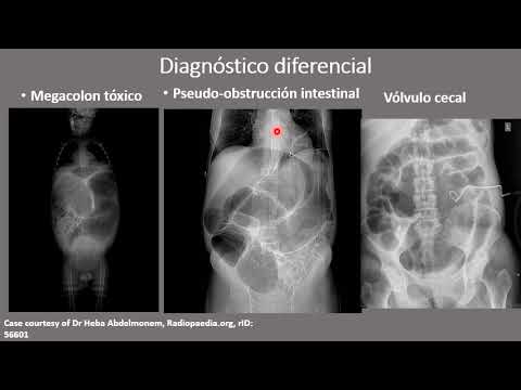 Vólvulo Sigmoide - Cirugia General (Colon parte 2) - YouTube