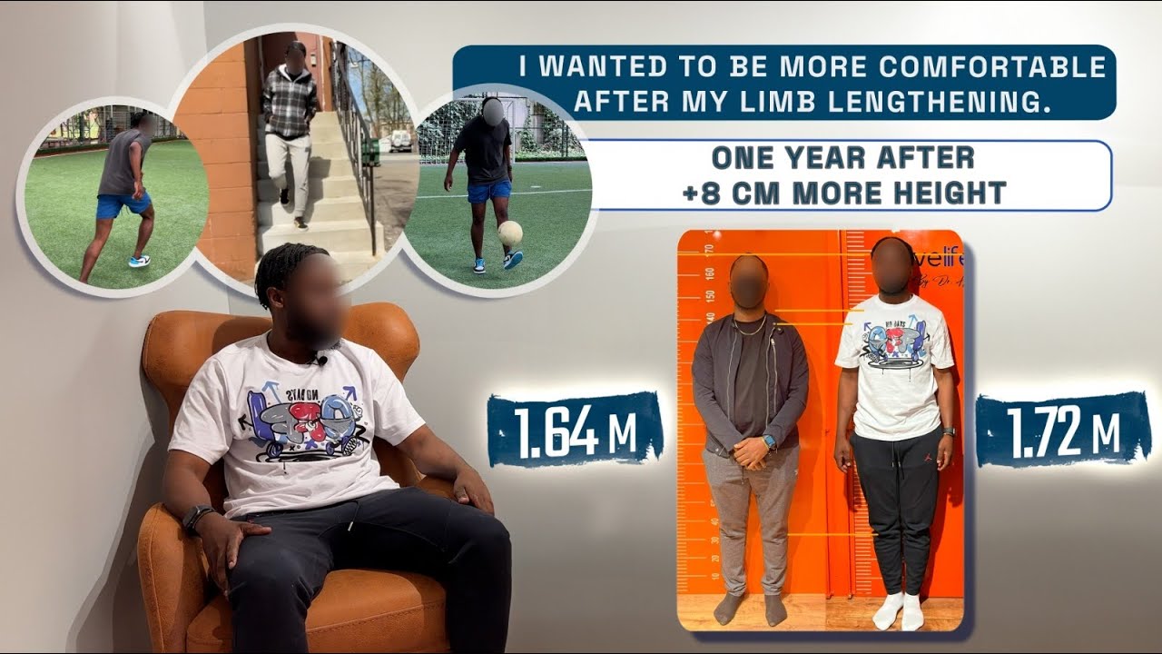 ONE YEAR AFTER +8 CM MORE HEIGHT WITH LIMB LENGTHENING - YouTube