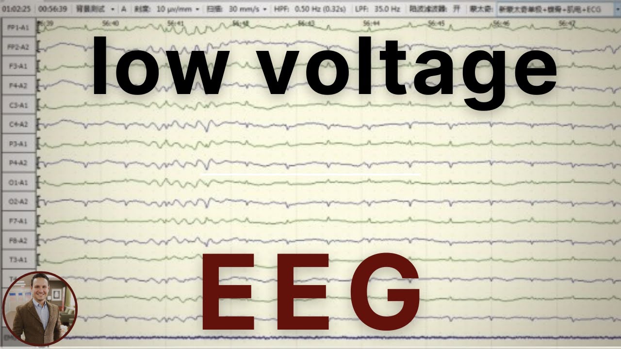Low-Voltage EEG Explained | Traumatic Brain Injury and Abnormal EEG ...