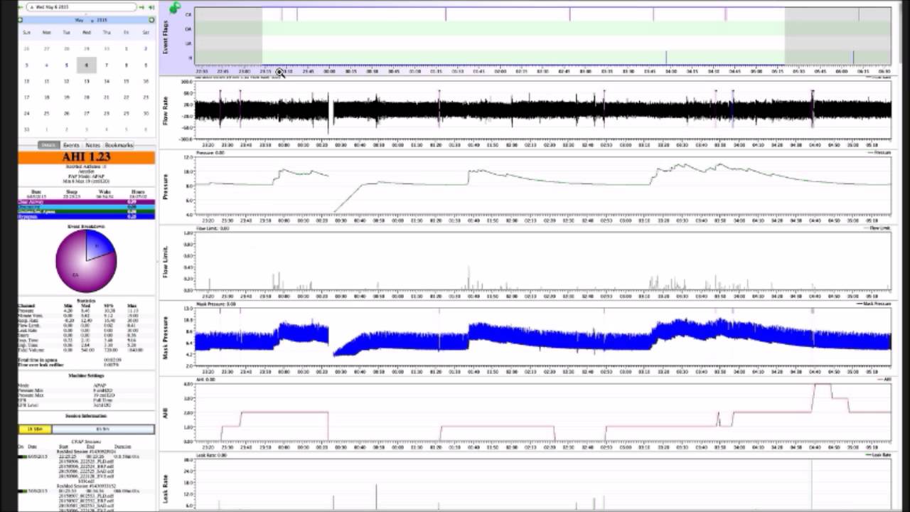 REM Specific Apnea and Problems with APAP Therapy. Interpret Sleep ...