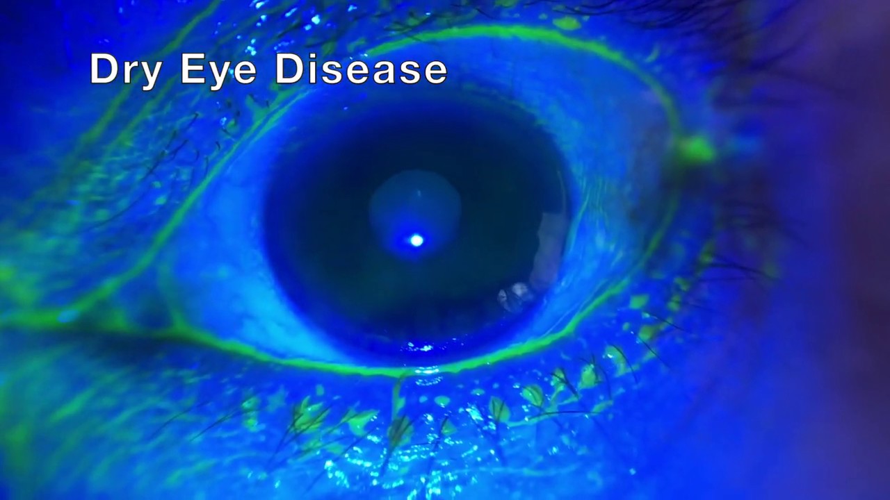 Dry Eye Disease - YouTube