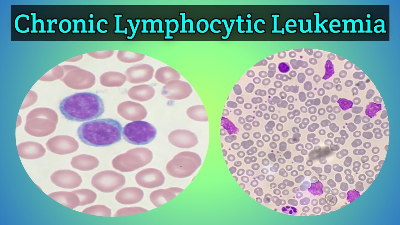 Chronic Lymphocytic Leukemia | Leukemia | Lymphoblast | Smear | CBC ...