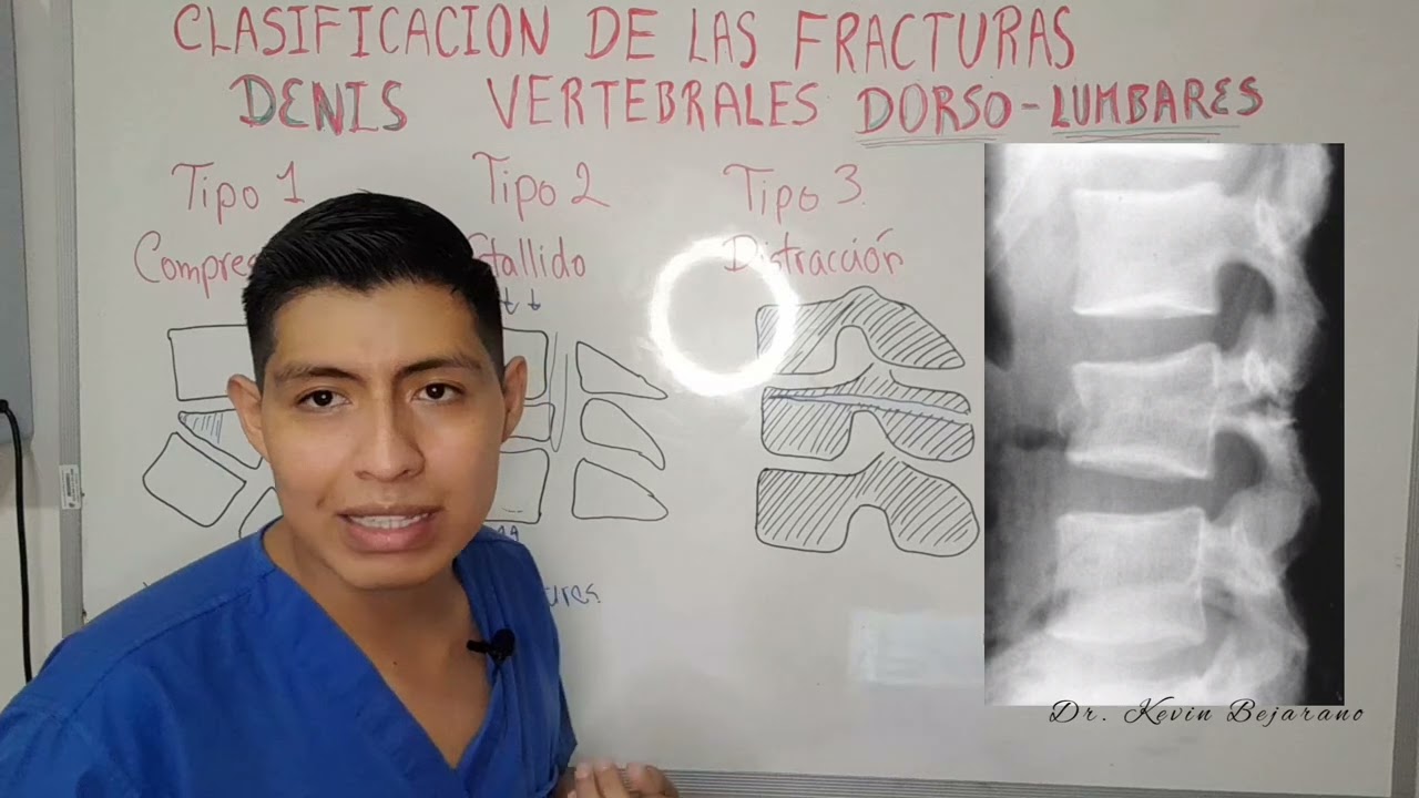 FRACTURAS VERTEBRALES DORSOLUMBARES clasificacion de DENIS, TERCERA ...