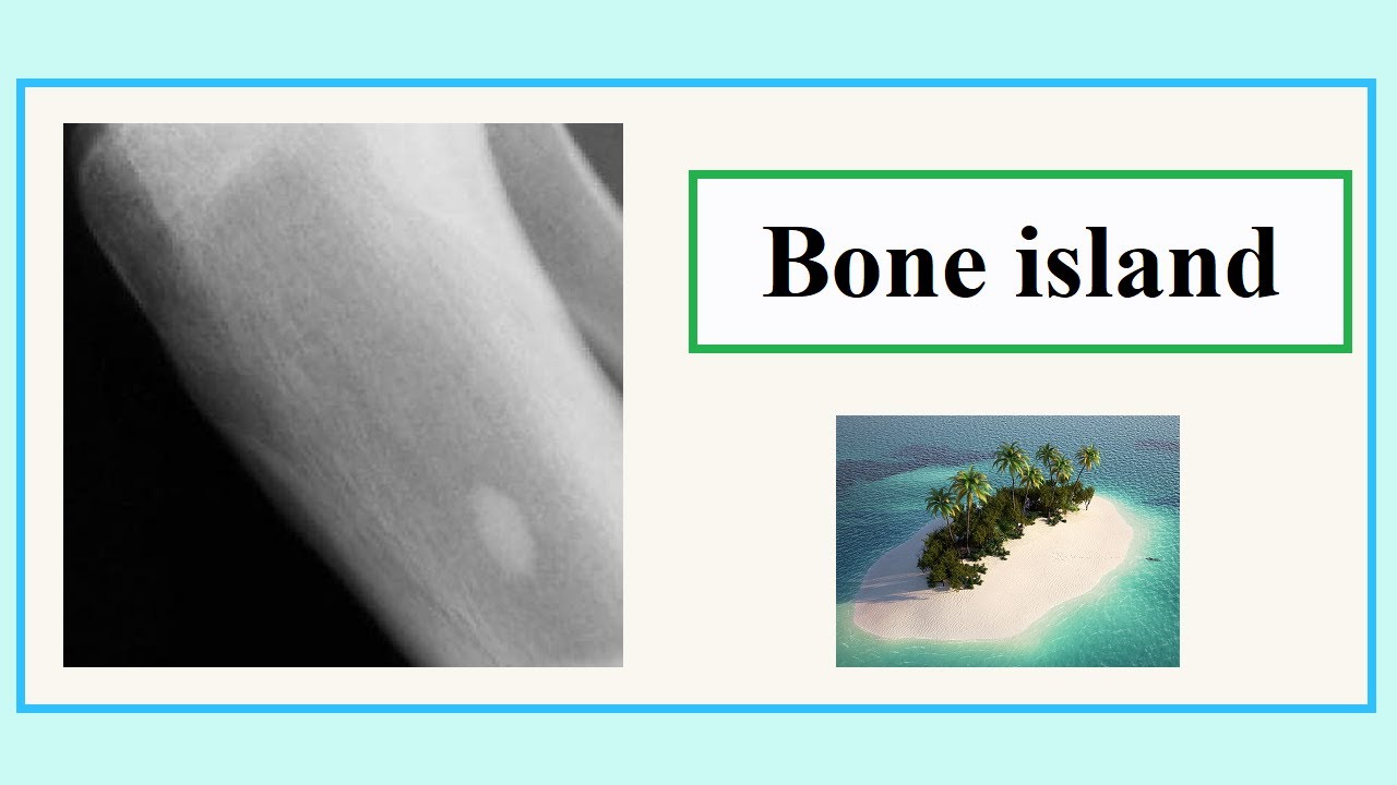 bone island - YouTube