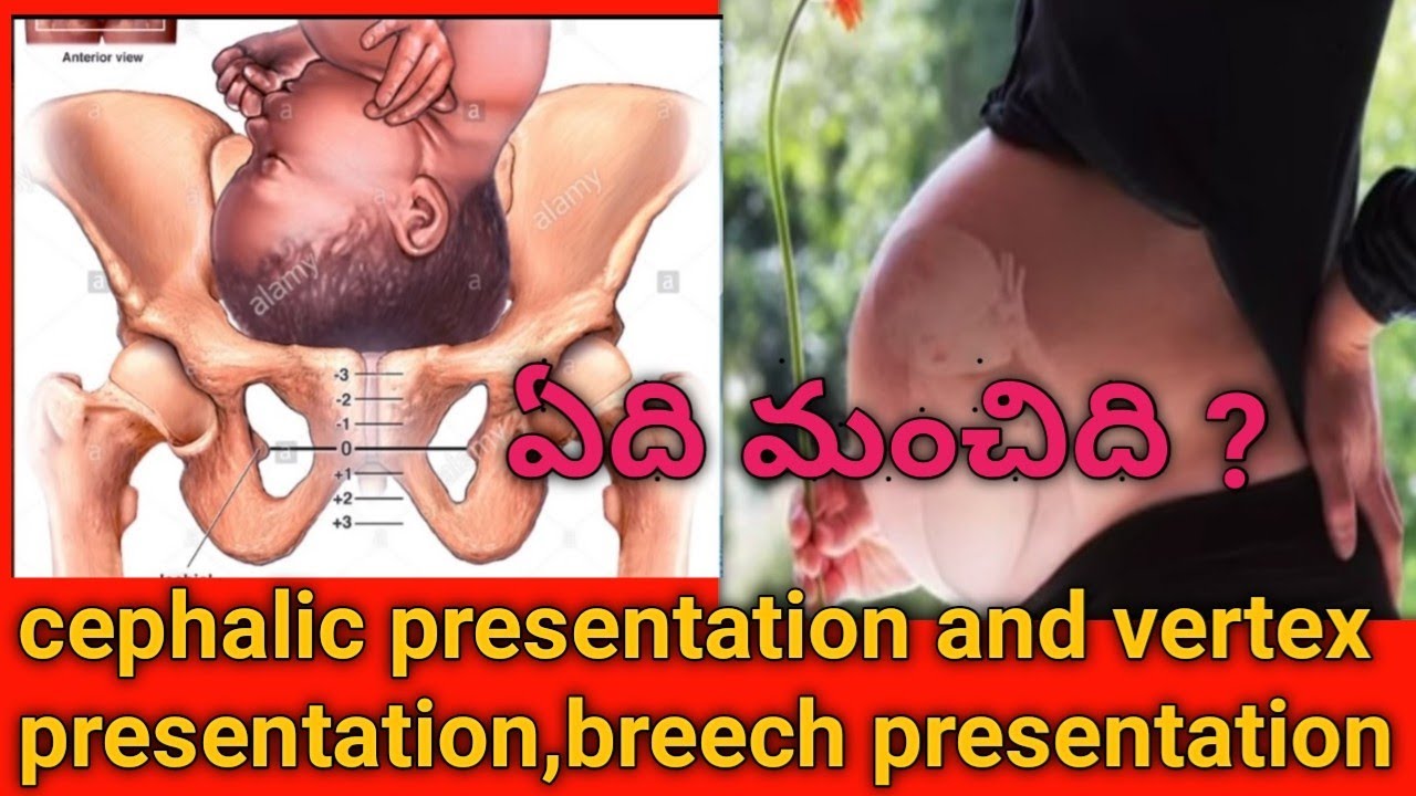Cephalic Presentation And Vertex Presentation And Breech Presentation cephalic-presentation-and-vertex-presentation-and-breech-presentation