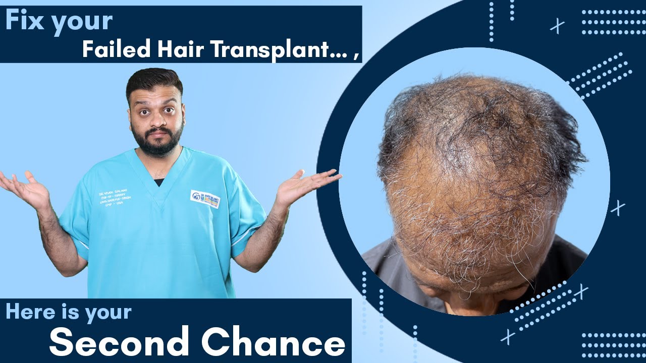 Failed/Bad Hair Transplant Correction | Is it even Possible to REPAIR ...