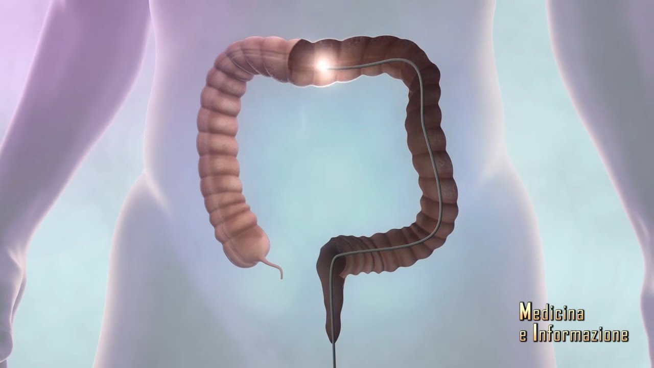 Tumore del colon retto: lo screening strumento prezioso per la ...
