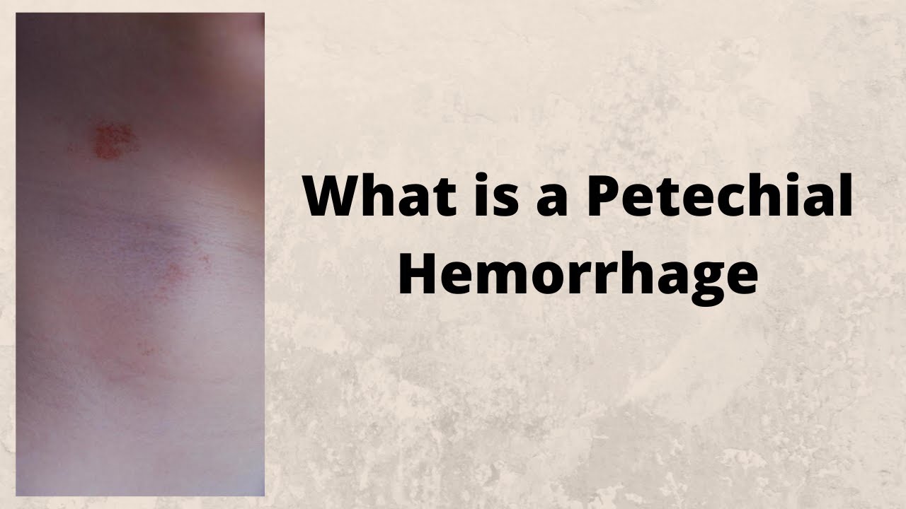 What Is A Petechial Hemorrhage YouTube what-is-a-petechial-hemorrhage-youtube